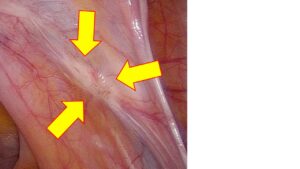 Peritoneal endometriosis - CEC